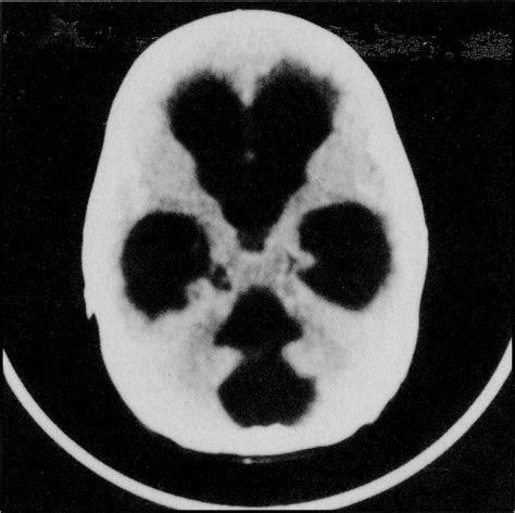 Unenhanced Axial Ct Scan Of The Brain Showing Marked Ventricular