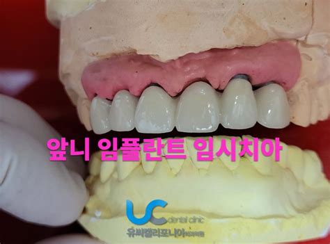 앞니 임플란트 Implant 수술 후기 임시치아 네이버 블로그