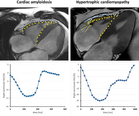 Feature Tracking Of The Endocardial And Epicardial Right Ventricle In Download Scientific