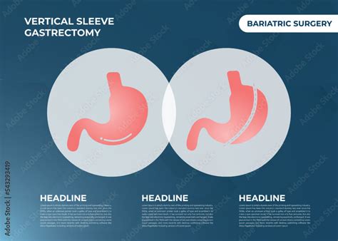 Laparoscopic Sleeve Gastrectomy Vertical Gastrectomy Weight Loss