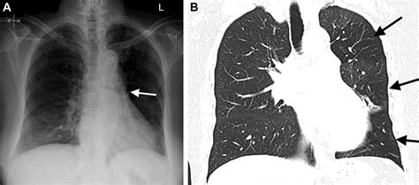 Lung Hyperlucency Chest