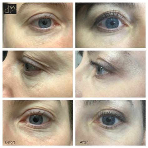 Active Fx Deep Fx Fractional Co2 Laser Resurfacing Dermatology Sa