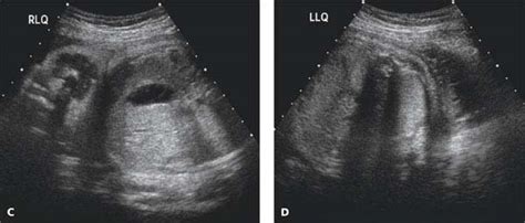 Amniotic Fluid Radiology Key