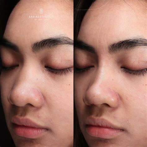 Non Surgical Rhinoplasty London Sas Aesthetics
