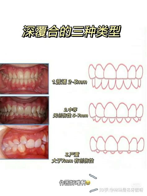 牙齿深覆合4问4答，露龈笑，轻度嘴凸怎么办？ 知乎