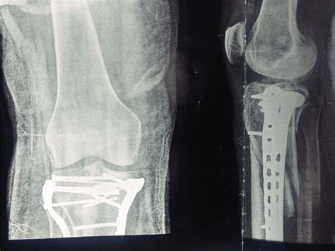 Immediate Postoperative Download Scientific Diagram