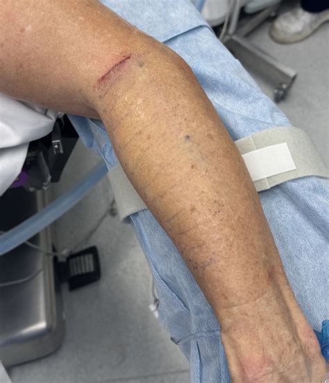 Left Forearm Implants Placement Dr Barry Eppley Explore Plastic Surgery