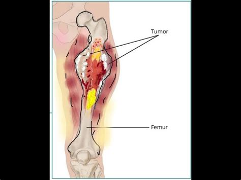 Ewing Sarcoma Tumor