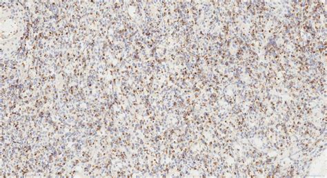 Extranodal NK T Cell Lymphoma Ottawa Atlas Of Pathology