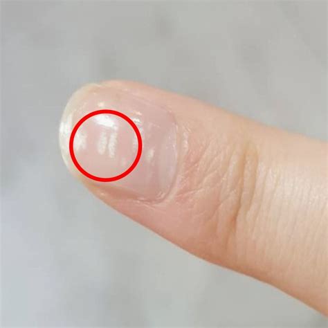 손톱 하얀점 생기는 요인 And 대처법 네이버 블로그