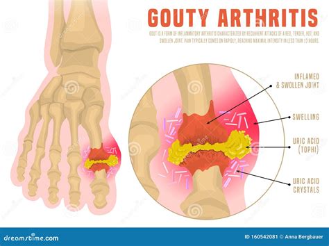 Gout Arthritis Infographic Stock Vector Illustration Of Arthropathy