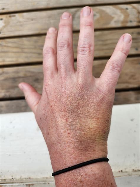 My Bruised Hand Rbruises