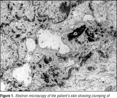 Figure 1 From The Use Of Tissue Engineered Skin Apligraf To Treat A