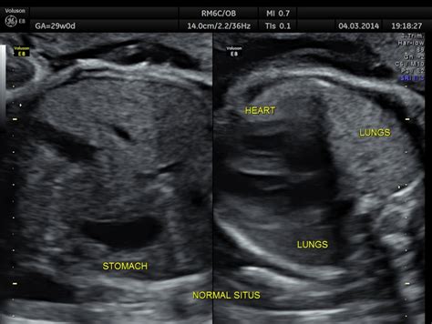 Choroid Plexus Cyst Looking Through A Transducer