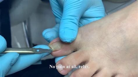 Repairing Curled Nail Relaxing Video Clip From YT YouTube