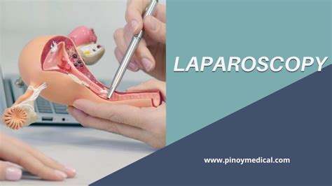 Laparoscopy Price In The Philippines 2025 — Pinoymedical