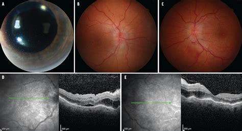 Ocular Toxicity Of New Age Cancer Therapies Retina Today