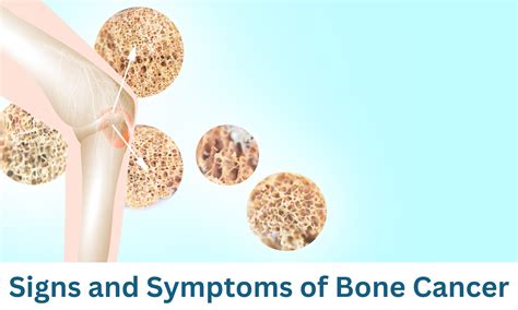 Signs And Symptoms Of Bone Cancer Proton Therapy