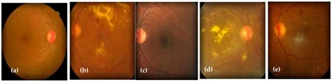 Dr Nasnet Automated System To Detect And Classify Diabetic Retinopathy Severity Using Improved