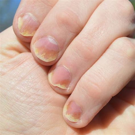 White Spots On Toenails After Removing Nail Polish