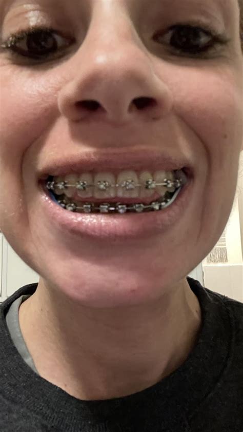 Underbite To Overbite R Jawsurgery