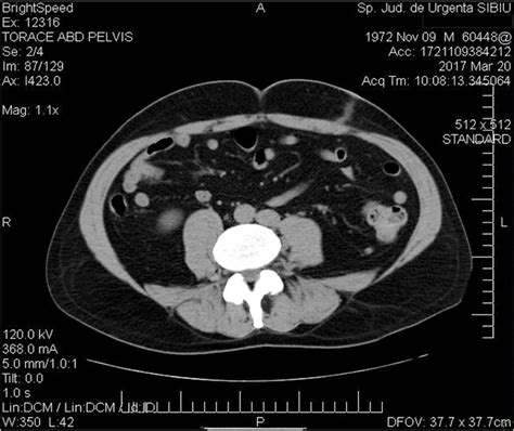 Cecum Appendix Agenesis Download Scientific Diagram