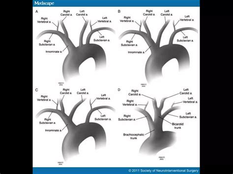 Complex Aortic Arch Surgery Pptx