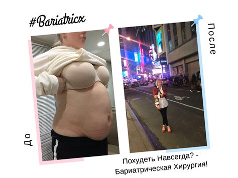 Результаты бариатрической хирургии до и после операции на желудке
