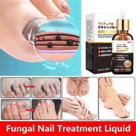 Fungal Nail Treatment Liquid Onychomycosis Repair Liquid Shopee Malaysia