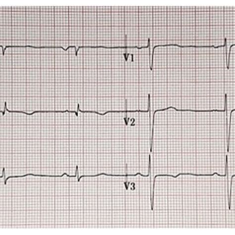 Electrocardiographic Features Of A Patient Affected By Left Dominant