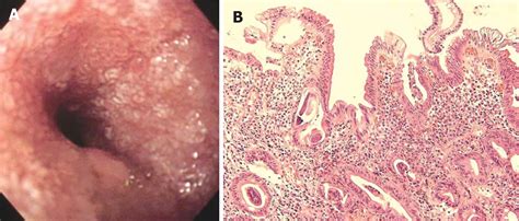 Abnormal Biopsy Endoscopy