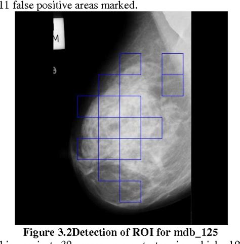 Figure 2 1 From Architectural Distortion Detection In Mammogram Using Contourlet Transform And