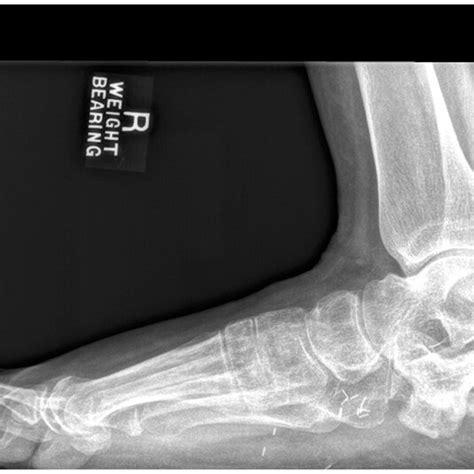 A Preoperative Lateral Weight Bearing Radiograph Of The Right Foot