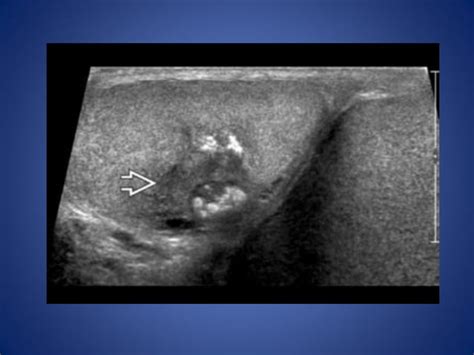 Testicular Calcifications Pdf