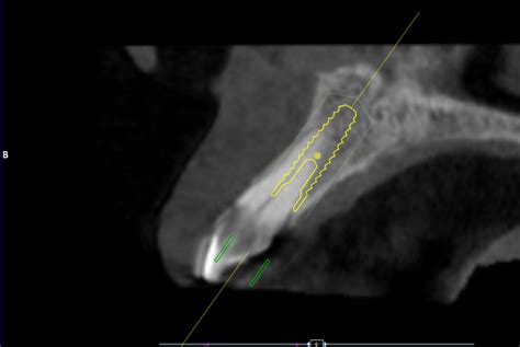 Implant Planning According To The Prosthetically Driven Implant