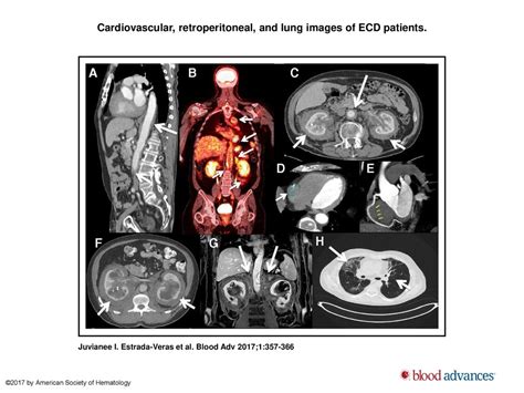 The Clinical Spectrum Of Erdheim Chester Disease An Observational
