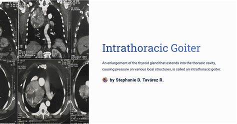 Intrathoracic Goiter