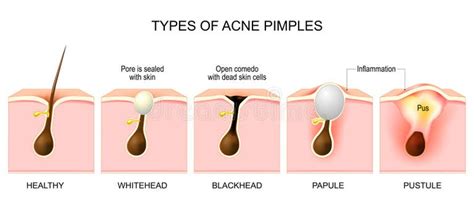 Types Of Acne Pimples Cross Section Of Skin And Hair Follicle Stock