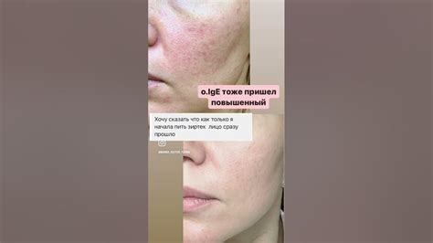 ДО ЛЕЧЕНИЯ и 2 НЕДЕЛИ СПУСТЯ Youtube