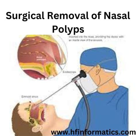 How To Remove Nasal Polyps Yourself