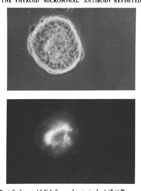 Figure 2 From The Thyroid Microsomal Antibody Revisited Its