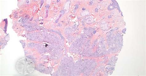 Sarcoidosis Pathology Image