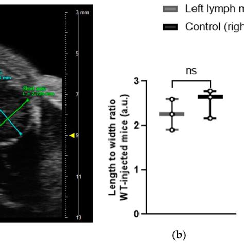 A 3d Us Frame Showing Hypoechogenic Tumor Draining Inguinal Ln The