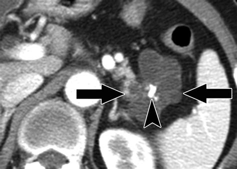 Serous Cystadenoma Pancreas