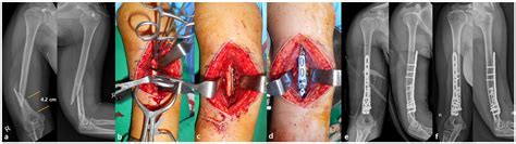 Comparative Analysis Of Anterolateral And Posterior Approaches For