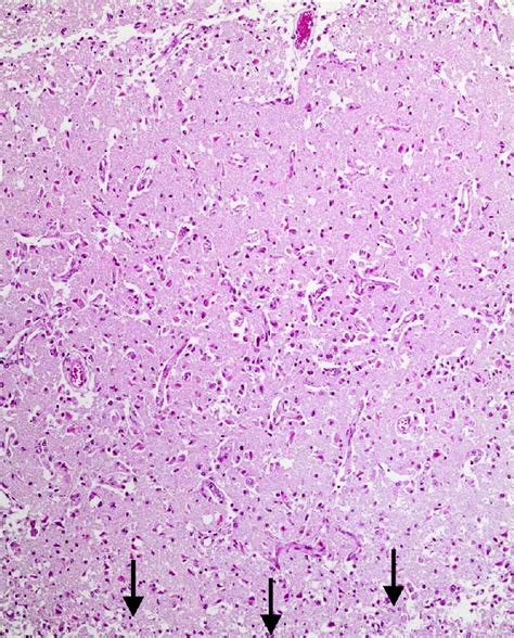 Severe Widespread Neuronal Necrosis In Sheep 3 With Infiltration By