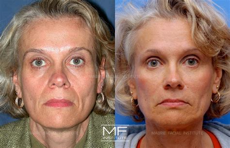 Nasolabial Fold Treatment With Filler And Botox® In The San Francisco Bay