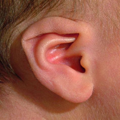 Ear Deformities Earwell