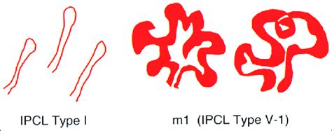 Schematic Drawing Of Typical Intrapapillary Capillary Loop Ipcl