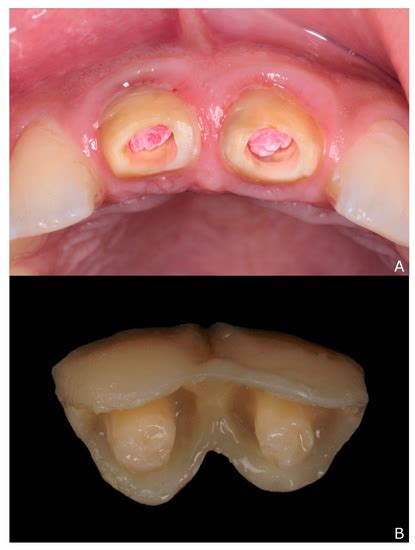 The Use Of Polyetheretherketone Peek As An Alternative Post And Core